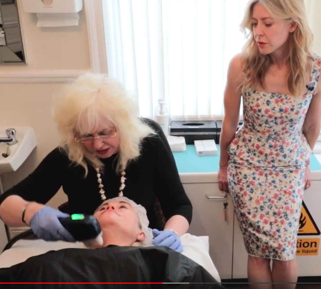 Lifting the face with Ultracel - The Tweakments Guide